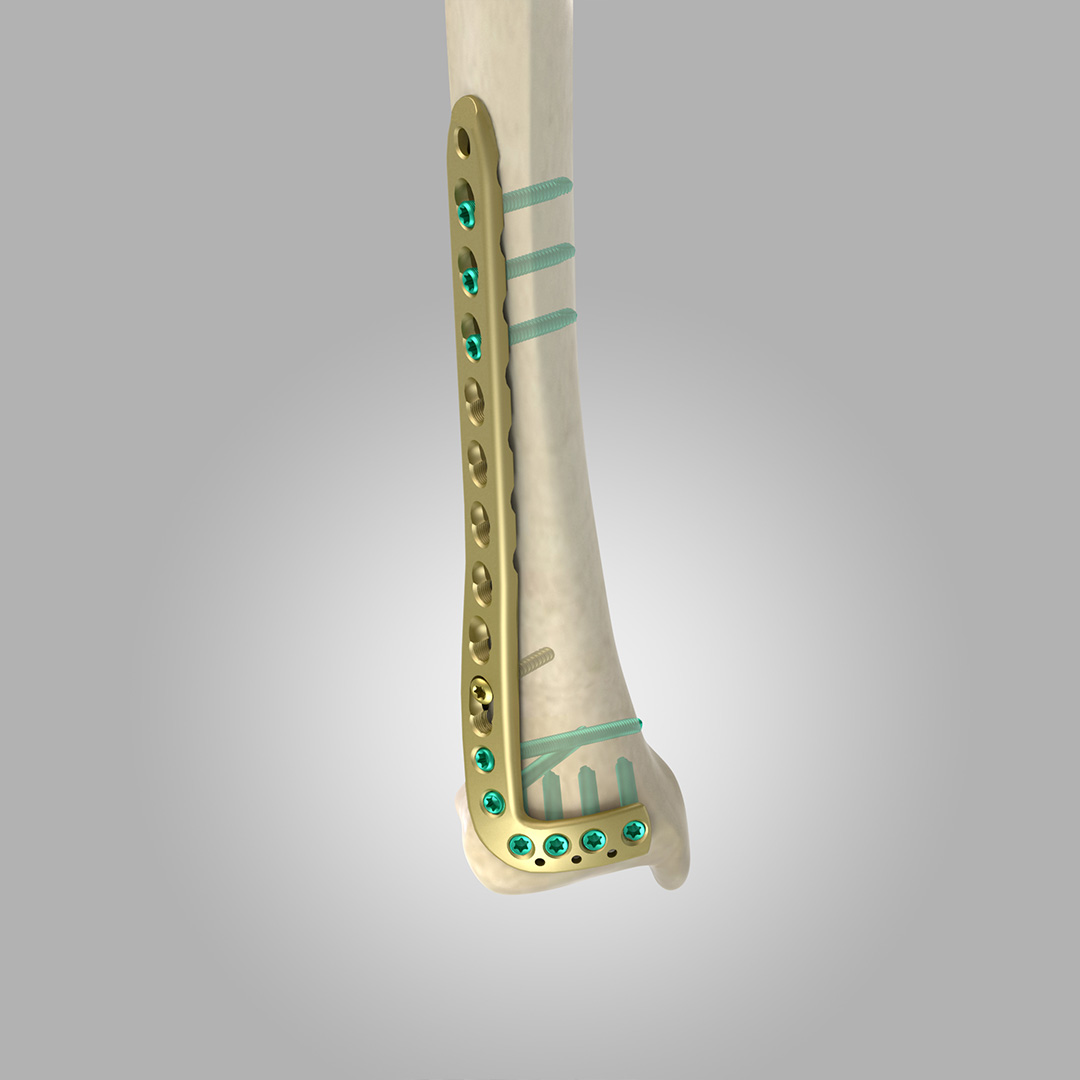 Plaque Lcp Tibia Distal – Plaques LCP pour tibia distal médial à faible ...